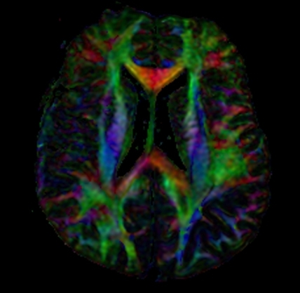 [BLOG POST] Brain Imaging: What Are the Different Types? – BrainLine ...
