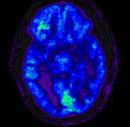 [BLOG POST] Brain Imaging: What Are the Different Types? – BrainLine ...