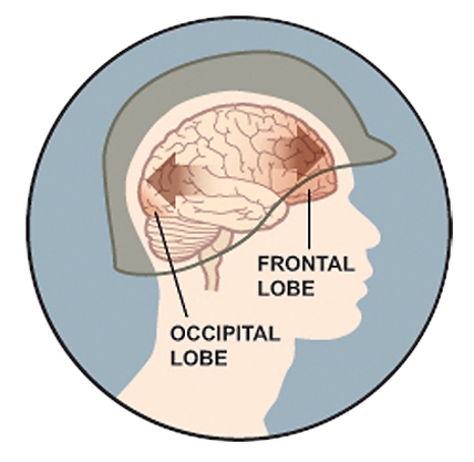 The Mechanics of a Blast Injury | BrainLine