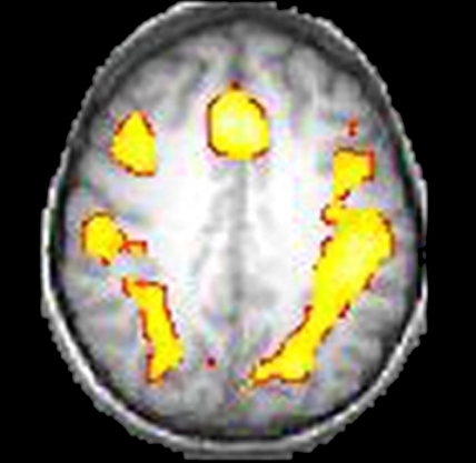 [BLOG POST] Brain Imaging: What Are the Different Types? – BrainLine ...