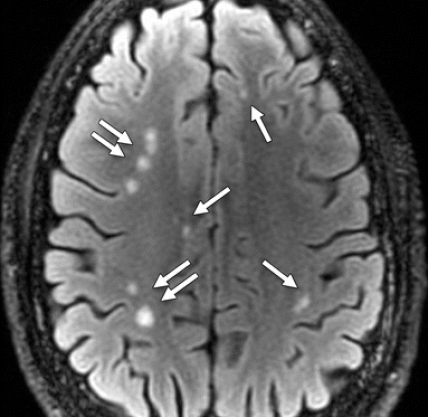 Visible Brain Damage Detected in MTBI From Blast Injuries | BrainLine